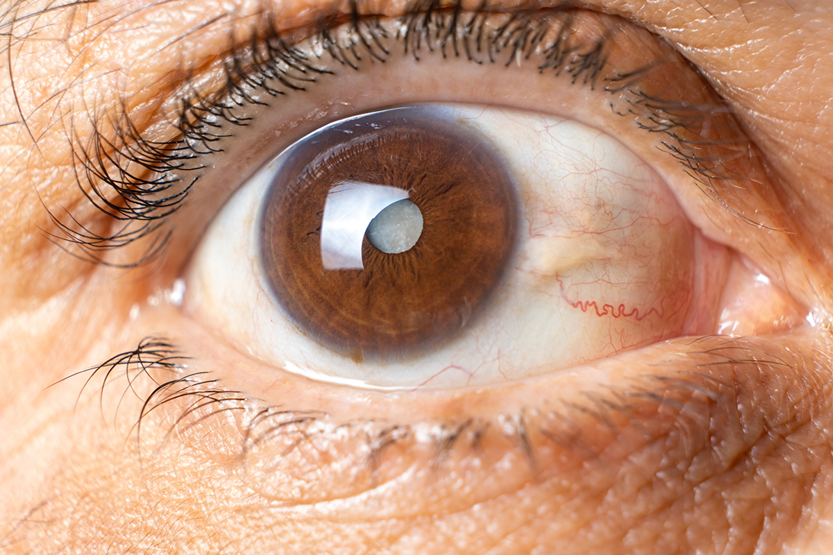 Progression of Cataracts - UVista